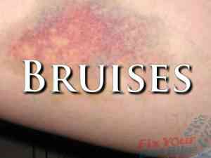 How To Treat A Bruise - Basic First Aid | Fix Your Dirt Bike